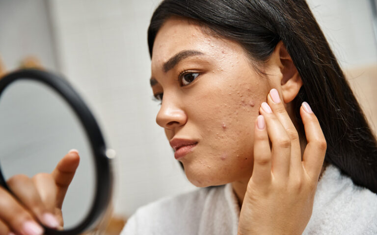 Acne - Non-Surgical Skin Treatments Long Beach, California