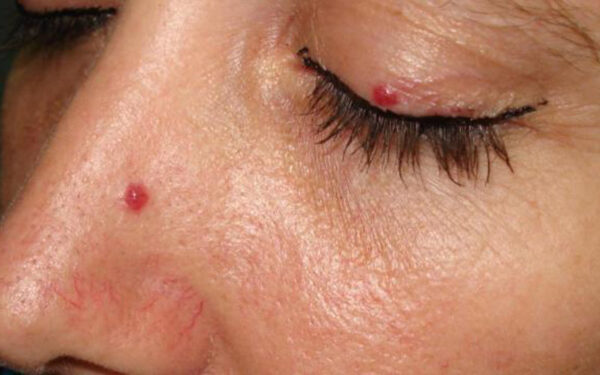 Cherry Angiomas - Laser & Cosmetic Treatments Long Beach